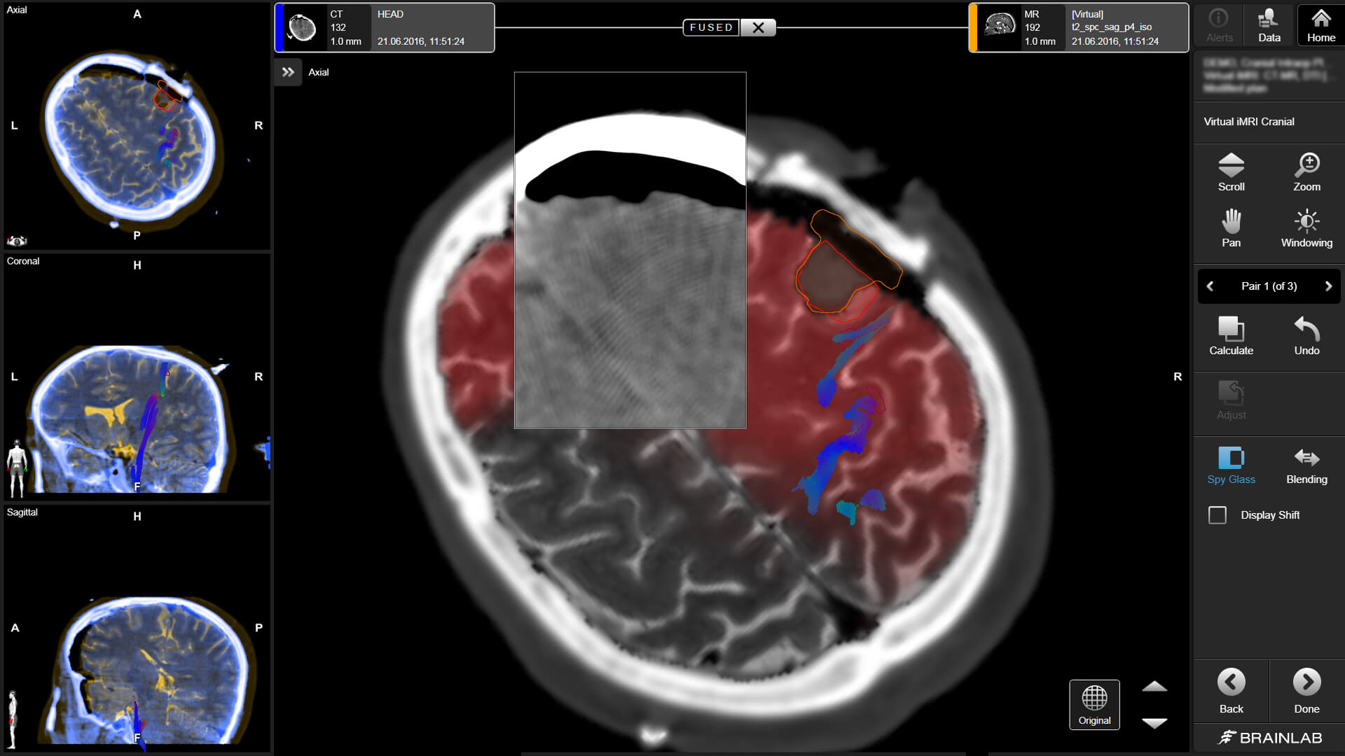 Cranial Planning with Elements: Software for Neurosurgery | Brainlab